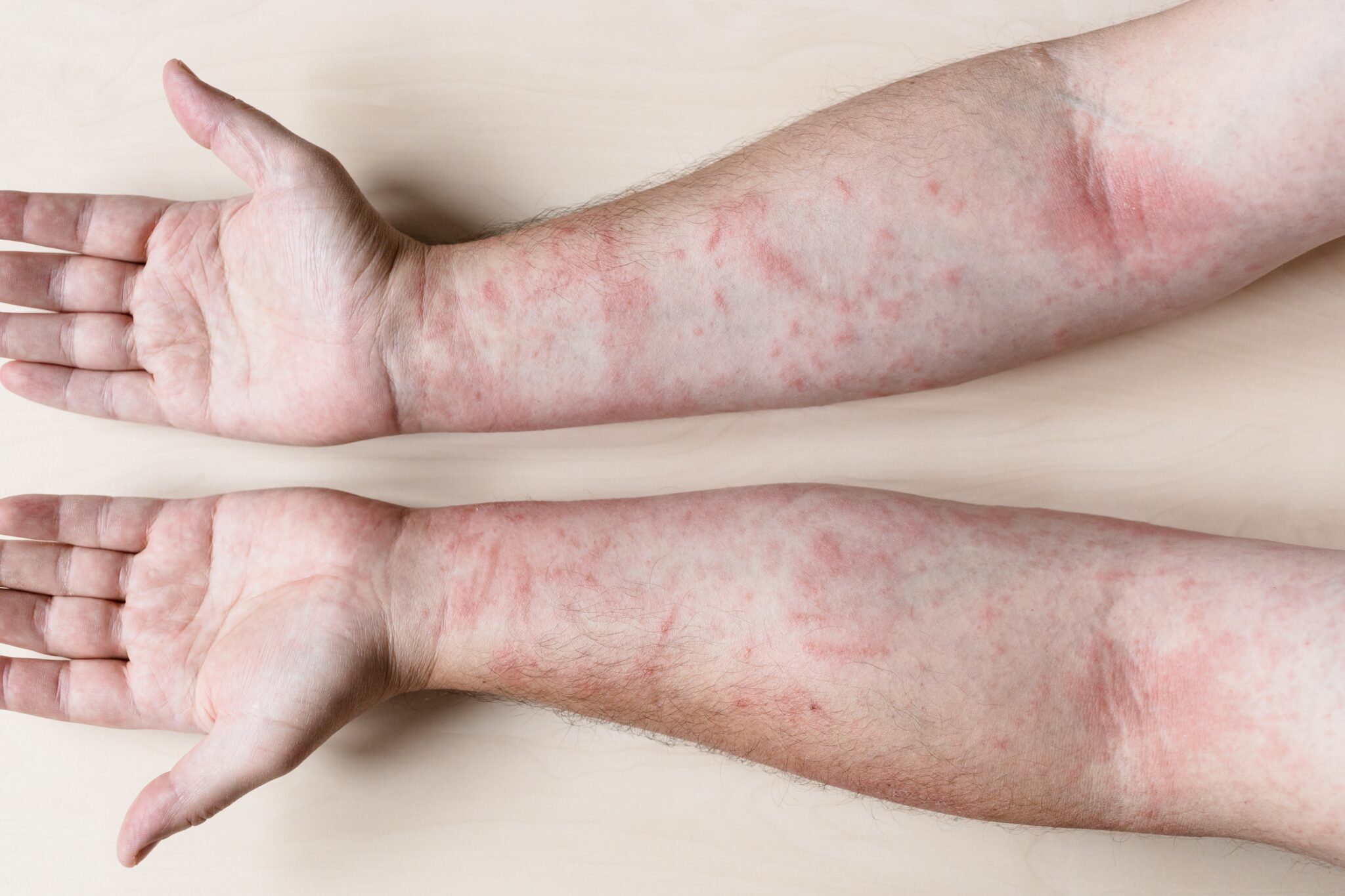 Allergic Contact Dermatitis Aonang Medical Clinic Allergic Contact Dermatitis Aonang Medical Clinic