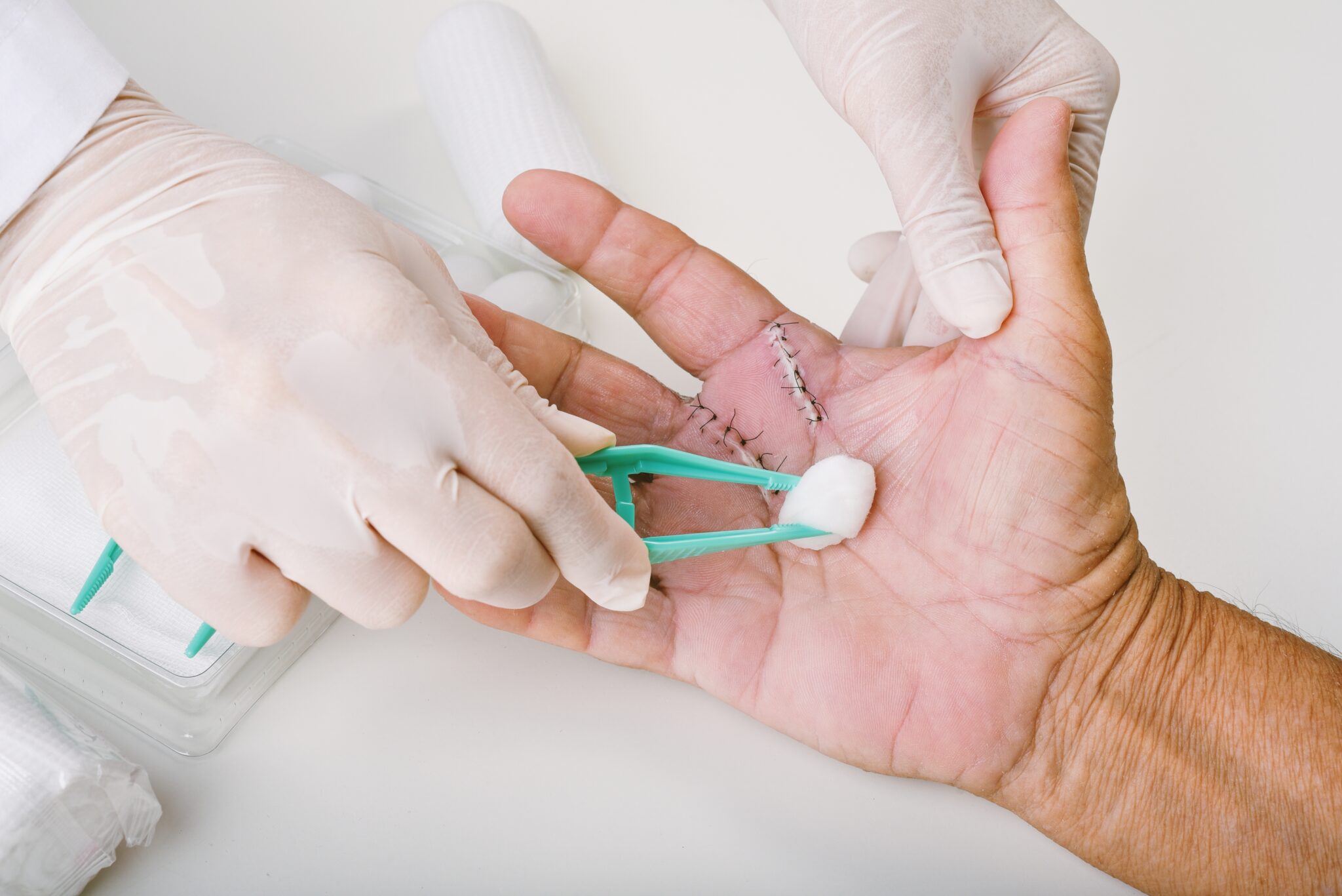 Wound Suturing - Aonang Medical Clinic
